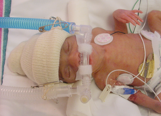 Post-discharge Care of the NICU Graduate / Late Preterm and Early Term ...