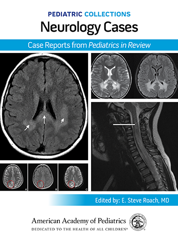 Rash, Diaphoresis, Anorexia, and Loss of Motor Skills in a 10-month-old ...