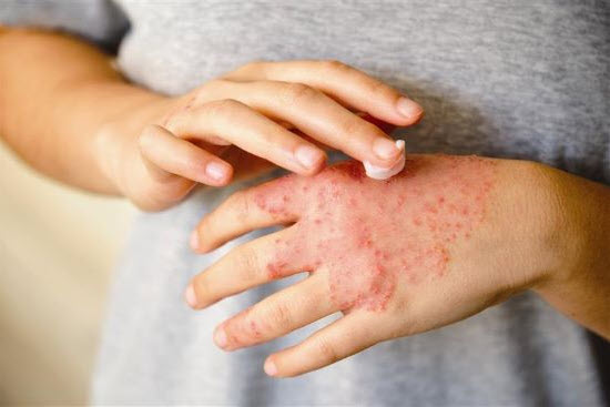 Managing atopic dermatitis: Revised AAP clinical report offers ...