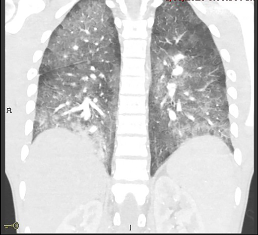 Diagnosis of EVALI in Adolescents During the COVID-19 Pandemic: A Case ...