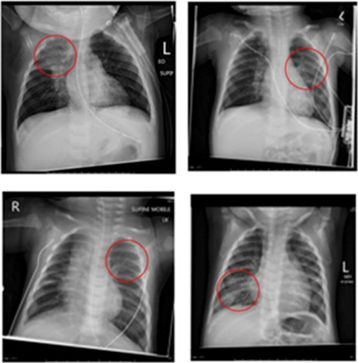 Bronchiolitis – The Simple Things in Life…. | Hospital Pediatrics ...