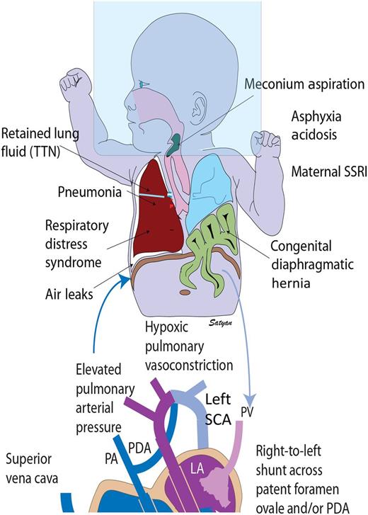 Persistent Pulmonary Hypertension of the Newborn | NeoReviews ...