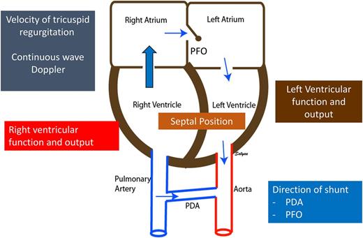 Persistent Pulmonary Hypertension of the Newborn | NeoReviews ...
