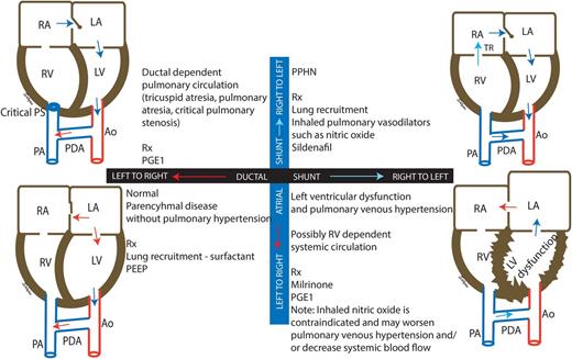 Persistent Pulmonary Hypertension of the Newborn | NeoReviews ...