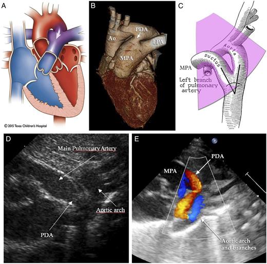 Diagnosis and Management of Patent Ductus Arteriosus | NeoReviews ...