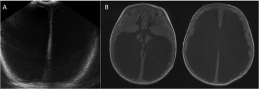 Neonatal Hydrocephalus | NeoReviews | American Academy of Pediatrics