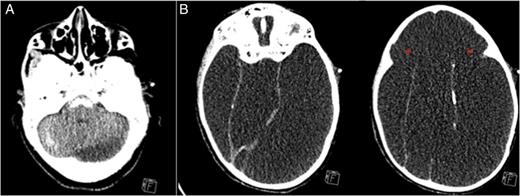 Neonatal Hydrocephalus | NeoReviews | American Academy of Pediatrics