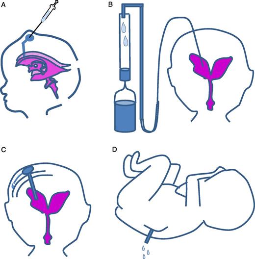 Neonatal Hydrocephalus | NeoReviews | American Academy of Pediatrics
