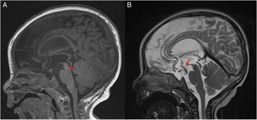 Neonatal Hydrocephalus | NeoReviews | American Academy of Pediatrics