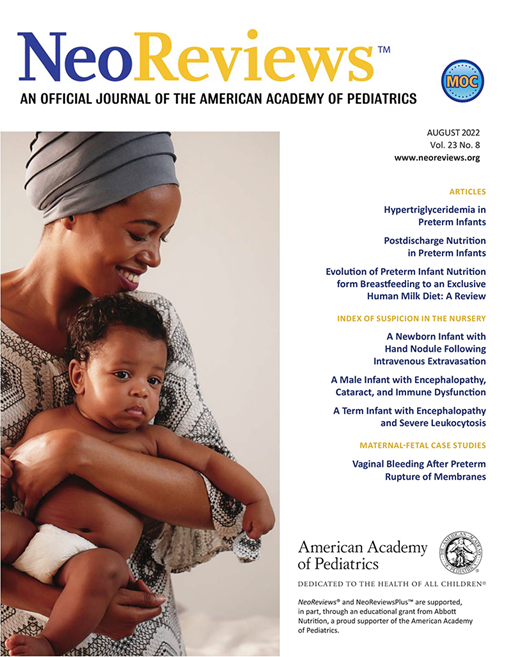 A Newborn Infant with Hand Nodule Following Intravenous Extravasation ...