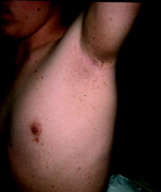 Health Supervision for Children With Neurofibromatosis | Pediatrics ...