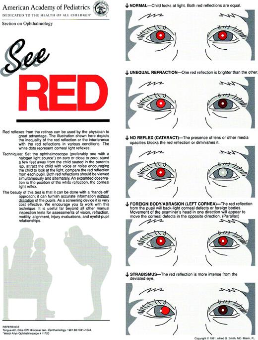 Red Reflex Examination in Neonates, Infants, and Children | Pediatrics ...