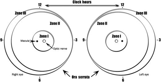 Screening Examination of Premature Infants for Retinopathy of ...