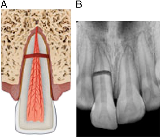 Management of Dental Trauma in a Primary Care Setting | Pediatrics ...