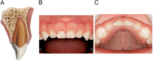 Management of Dental Trauma in a Primary Care Setting | Pediatrics ...