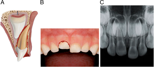 Management of Dental Trauma in a Primary Care Setting | Pediatrics ...