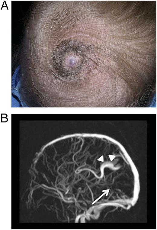 Congenital Brain and Spinal Cord Malformations and Their Associated ...