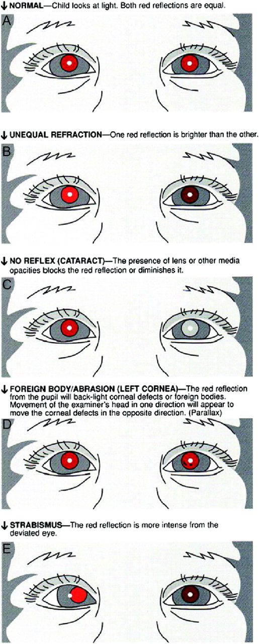 Procedures for the Evaluation of the Visual System by Pediatricians ...