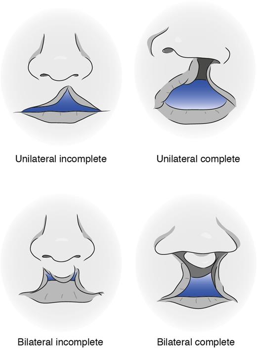 The Primary Care Pediatrician and the Care of Children With Cleft Lip ...