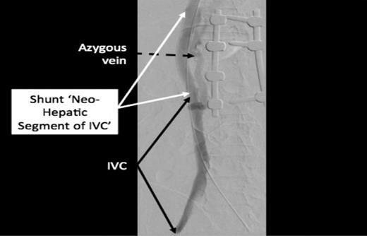 Congenital Inferior Vena Cava Atresia Presenting as Extensive ...