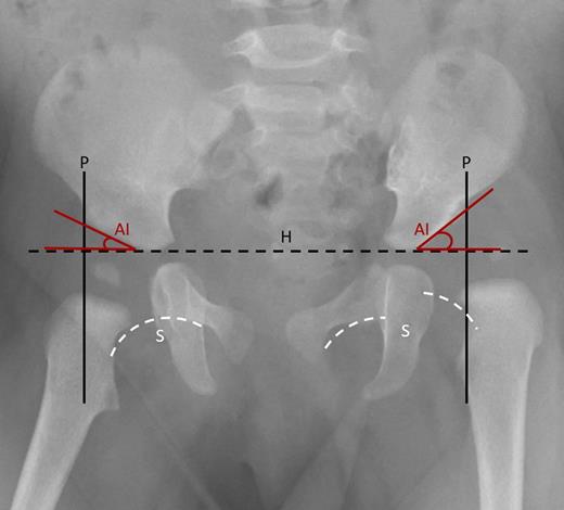 Developmental Dysplasia of the Hip | Pediatrics | American Academy of ...