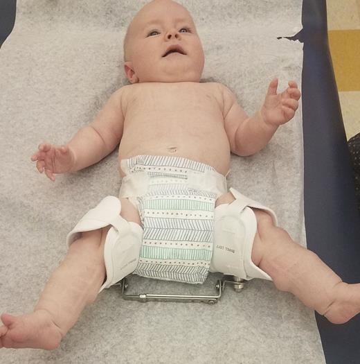 Developmental Dysplasia of the Hip | Pediatrics | American Academy of ...