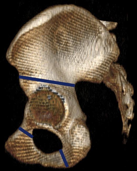 Developmental Dysplasia of the Hip | Pediatrics | American Academy of ...