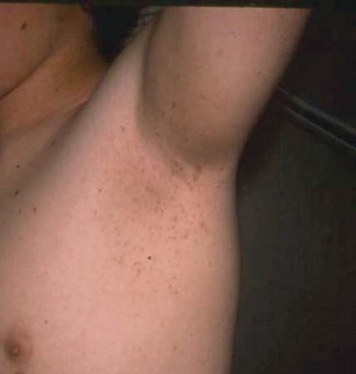 Health Supervision for Children With Neurofibromatosis Type 1 ...