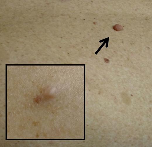 Health Supervision for Children With Neurofibromatosis Type 1 ...