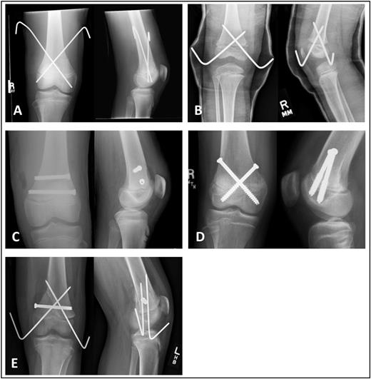 Salter-Harris II Fractures of the Distal Femur: Does displacement, size of Thurston-Holland ...