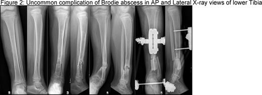 Brodie Abscess: Case Series of 15 Pediatric Patients Treated Surgically ...
