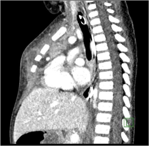(22) Primary sternal osteomyelitis in a 2-year-old infant with an ...