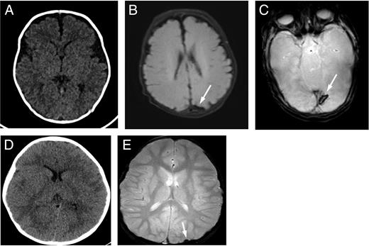 Feasibility and Accuracy of Fast MRI Versus CT for Traumatic Brain ...
