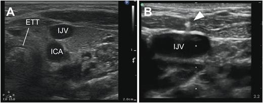 Seeing Is Believing: Ultrasound in Pediatric Procedural Performance ...