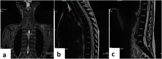 Paraspinal extramedullary hematopoiesis in beta thalassemia Intermedia ...