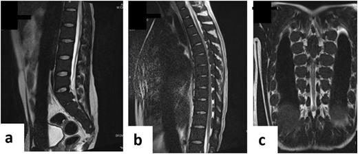 Paraspinal extramedullary hematopoiesis in beta thalassemia Intermedia ...