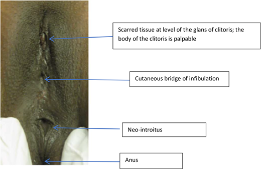 Diagnosis, Management, and Treatment of Female Genital Mutilation or ...