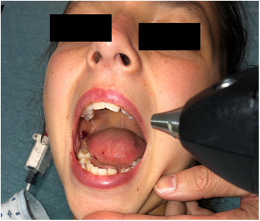 Immune Thrombocytopenia (ITP) in a Pediatric Patient Positive for SARS ...