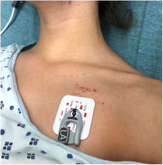 Immune Thrombocytopenia (ITP) in a Pediatric Patient Positive for SARS ...