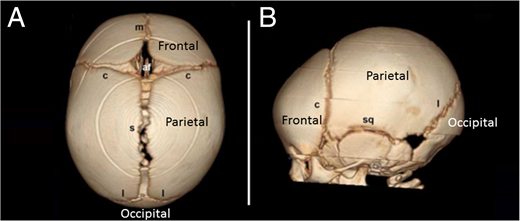 Identifying the Misshapen Head: Craniosynostosis and Related Disorders ...