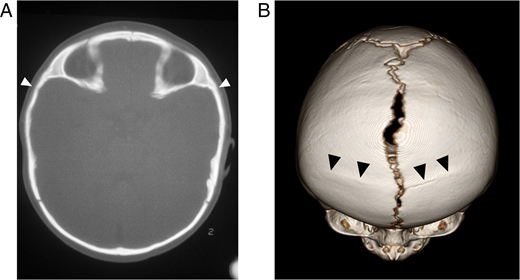 Identifying the Misshapen Head: Craniosynostosis and Related Disorders ...