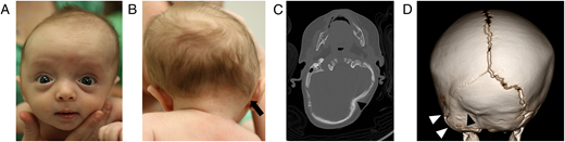 Identifying the Misshapen Head: Craniosynostosis and Related Disorders ...
