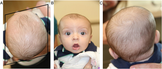 Identifying the Misshapen Head: Craniosynostosis and Related Disorders ...