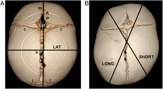 Identifying the Misshapen Head: Craniosynostosis and Related Disorders ...