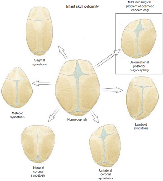 Identifying the Misshapen Head: Craniosynostosis and Related Disorders ...