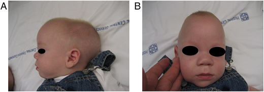 Identifying the Misshapen Head: Craniosynostosis and Related Disorders ...