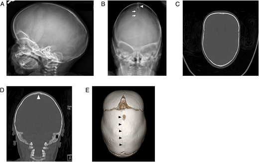 Identifying the Misshapen Head: Craniosynostosis and Related Disorders ...