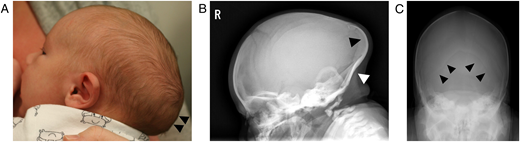 Identifying the Misshapen Head: Craniosynostosis and Related Disorders ...