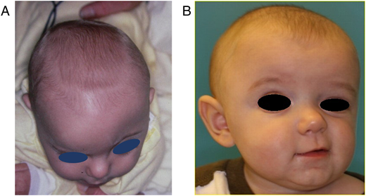 Identifying the Misshapen Head: Craniosynostosis and Related Disorders ...