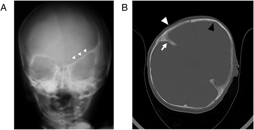 Identifying the Misshapen Head: Craniosynostosis and Related Disorders ...